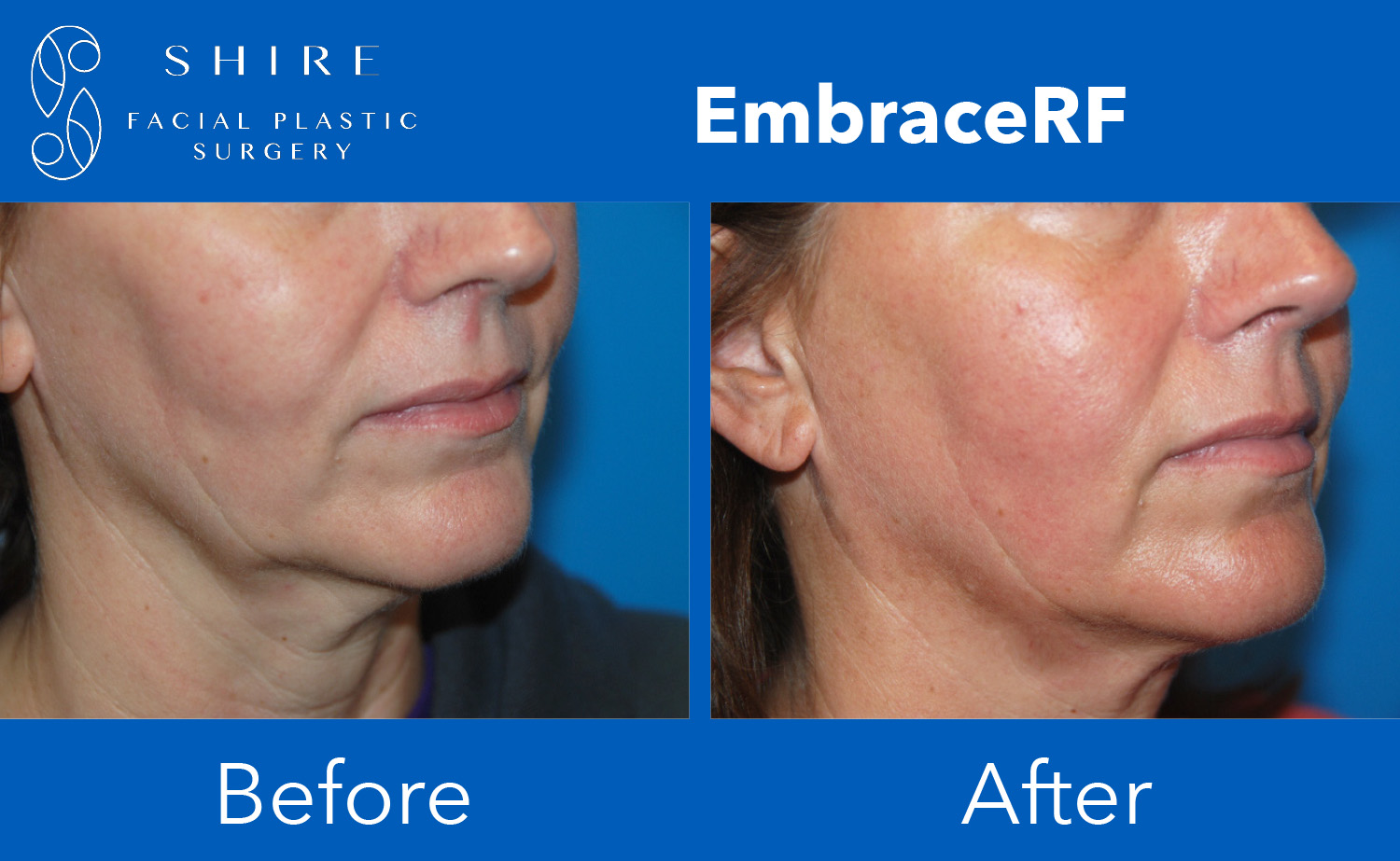 EmbraceRF Before & After | Shire Facial Plastic Surgery